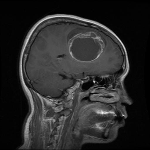 Revolutionizing Radiology Integrating Machine Learning Models For Enhanced Brain Tumor