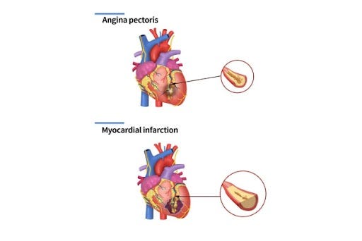 Difference Between Angina and MI. Angina and myocardial infarction (MI)… | by Anurag rawat | Medium