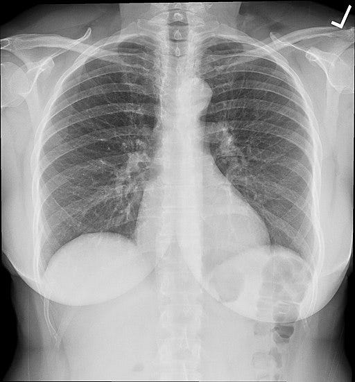 Hidden in Plain Sight — The Prognostic Value of Chest X-Rays | by ...