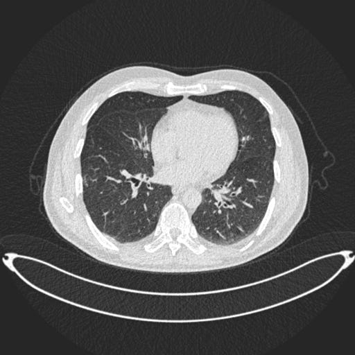 Image Classification for Prediction of Lung Cancer | by Zulfikar Irham | Python in Plain English