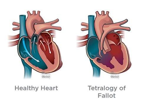Understanding Tetralogy Of Fallot Pathophysiology: A Comprehensive Overview | by Anurag rawat ...