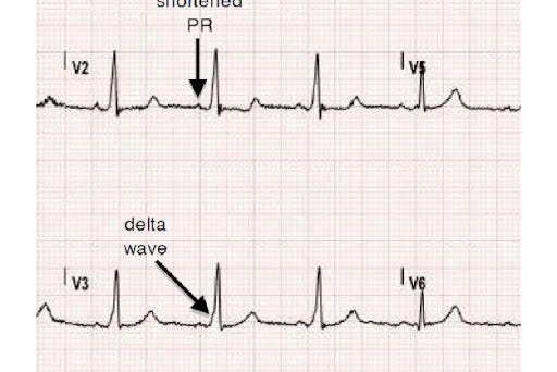 Decoding Delta Wave ECG: A Comprehensive Guide | by Anurag rawat | Aug, 2024 | Medium