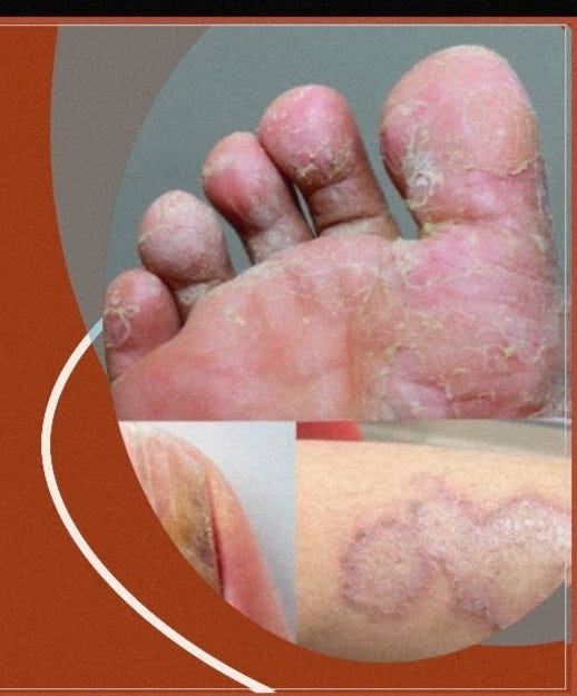 Dermatomycosis with representative example of tinea Nigra | by Uzair | Oct, 2024 | Medium