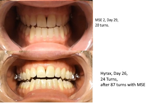 Hyrax + Follow-up Jaw Surgery Consult | by Class 3 MSE | Medium