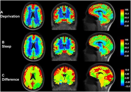 Brain studies show sleep loss impacts health | Medium