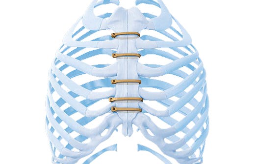 Medical Sternal Fixation Systems Market will exhibit strong growth from ...