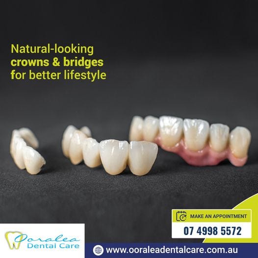 Natural-Looking Crowns & Bridges For Better Life-Style | by ...