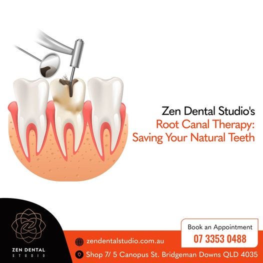 Zen Dental Studio’s Root Canal Therapy: Saving Your Natural Teeth | by ...