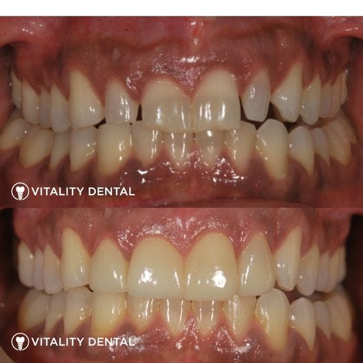 before and after photos of a veneer case !!! - Vitality Dental ...