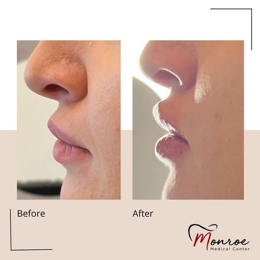 Book your magical lip transformation - Robertandro - Medium