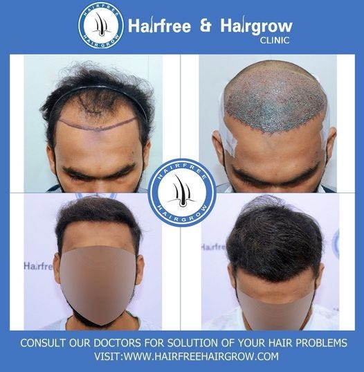 Female Hair Transplant “only Hairfree And Hairgrow Clinic Is The… By