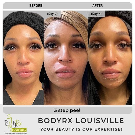 ZO three step chemical peel Event - Bodyrx Louisville - Medium