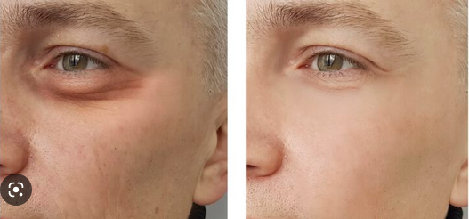 Filling tear troughs might help to lessen eye bags and wrinkles. | by ...