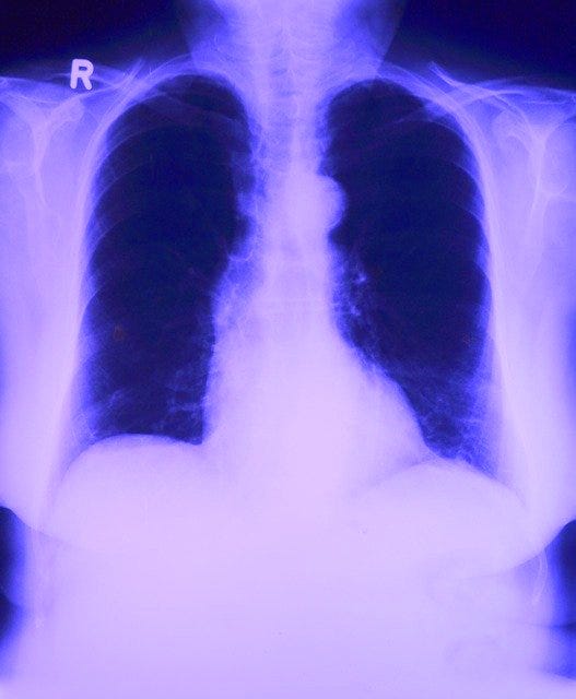 The White Plague: Tuberculosis in Early America | by Glenn Fay, Jr ...