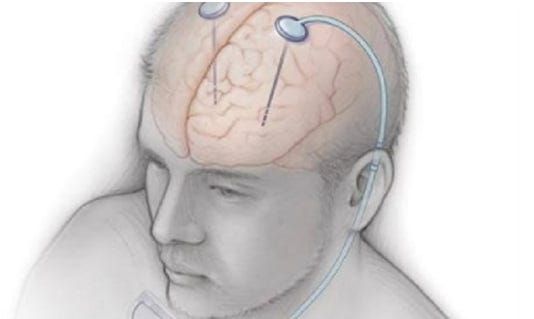 Researchers working on implant device to cure cancer with mobile app in ...