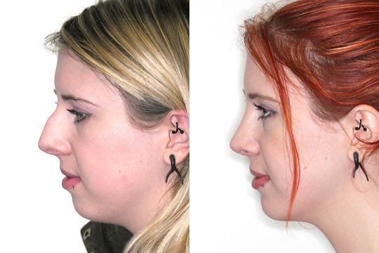 Rhinoplasty — Create a More Appealing and Attractive Nose | by Ankit ...