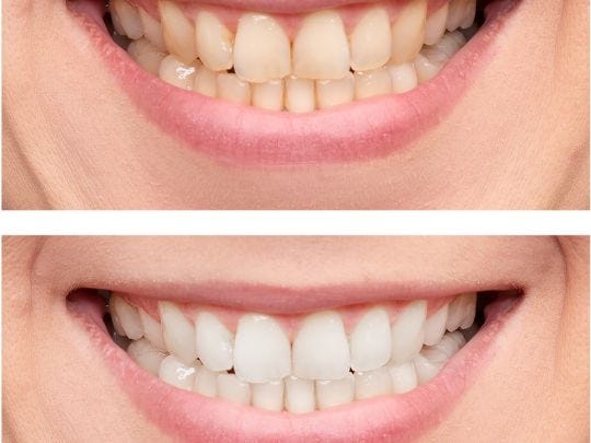 Yellow Teeth Don’t Have to Stay That Way! Achieve a Brighter Smile with ...