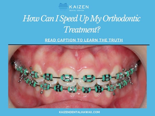 How Can I Speed Up My Orthodontic Treatment?How Can I Speed Up My ...