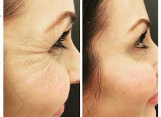 The Science Behind Profhilo Treatments: How They Work and What to ...