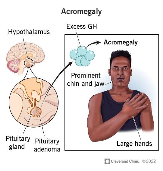 ACROMEGALY. Hormonal disorder | by Jean B | Oct, 2024 | Medium