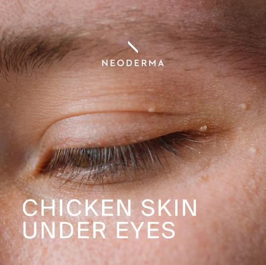 Chicken Skin Under Eyes | NEODERMA | by NEODERMA | Jul, 2024 | Medium