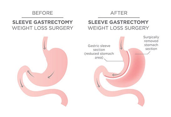 Sleeve Gastrectomy. Sleeve Gastrectomy, also known as… | by Parth Naik ...