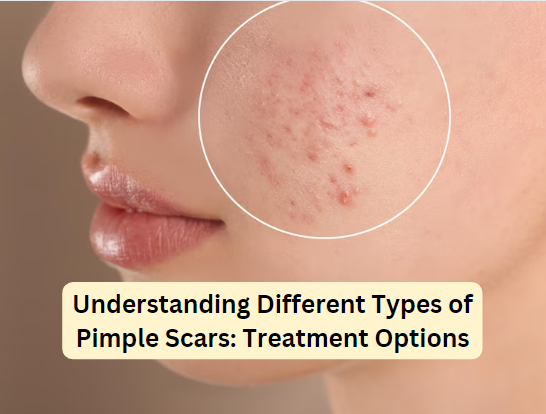 Different Types of Pimple Scars: Treatment Options | Medium
