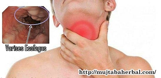 OBAT VARISES ESOFAGUS TERBUKTI DAPAT SEMBUH TOTAL | by justinbieber ...