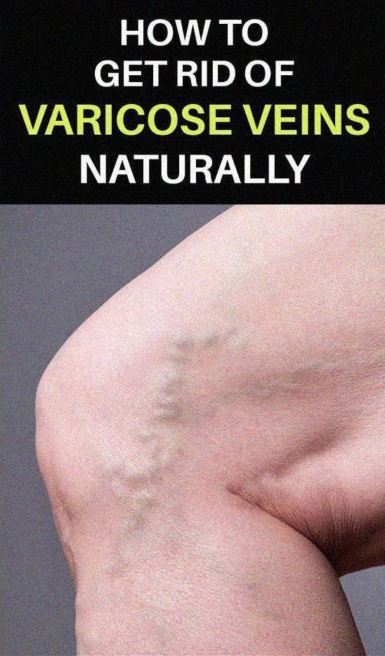 How to Get Rid of Varicose Veins Naturally - Joel Parris - Medium