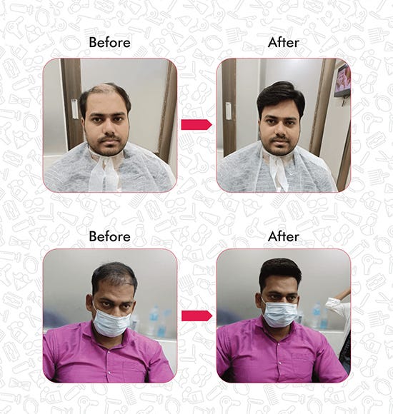 Making Informed Choices: Hair Replacement vs. Other Hair Restoration Options | by Grow Brite ...