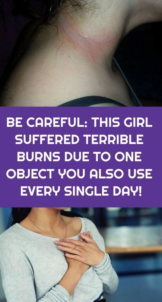 BE CAREFUL: THIS GIRL SUFFERED TERRIBLE BURNS DUE TO ONE OBJECT YOU ...