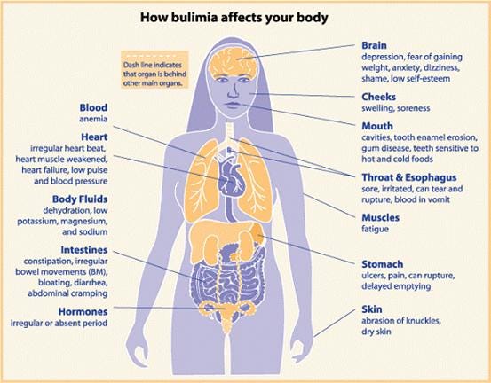 Understanding Bulimia: Unveiling the Complexities of Eating Disorders ...