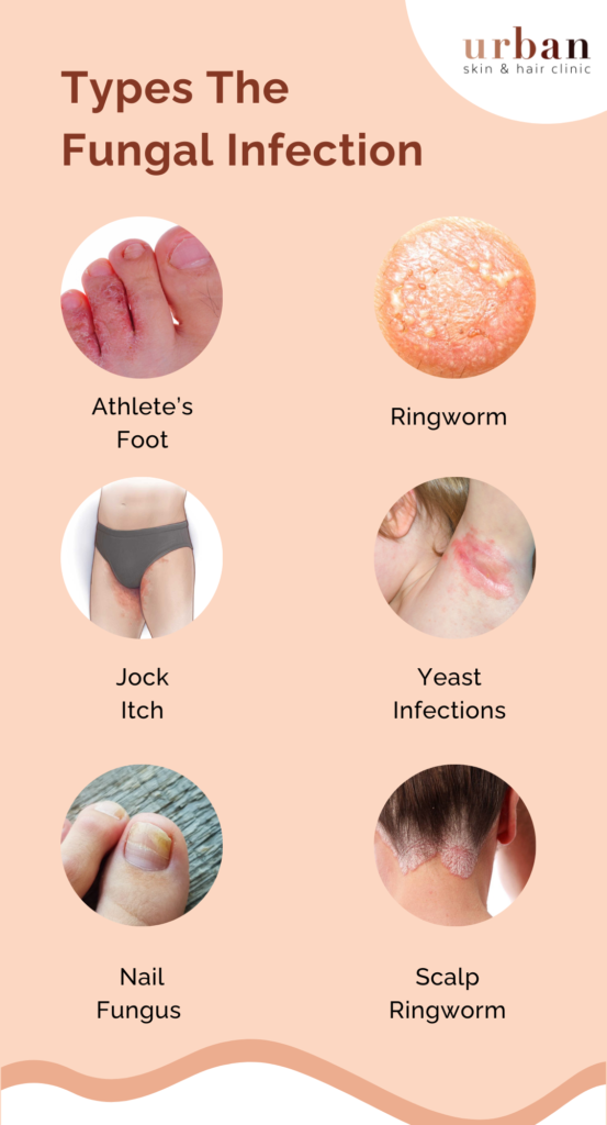 Fungal infection and its types | by Akmal Malik | Medium