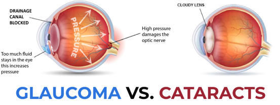 What are the differences between cataract treatment and glaucoma ...