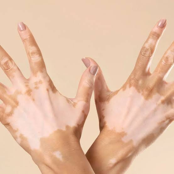 WHAT IS VITILIGO.. Vitiligo is a long-term skin condition… | by Dr TS ...