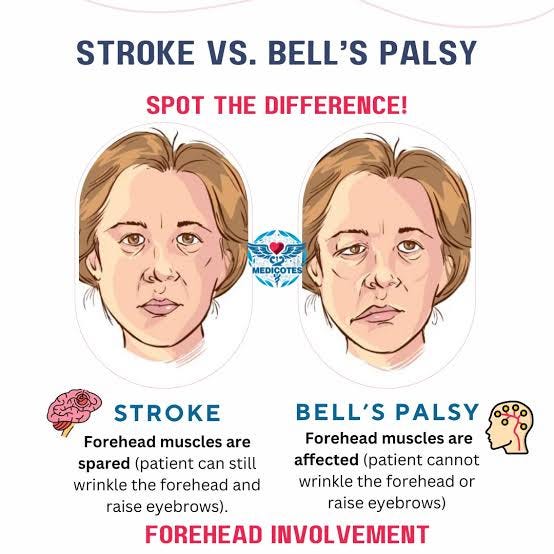 Bell’s Palsy vs Stroke—A Face Can Speak the Truth | by Adaora Alaere ...