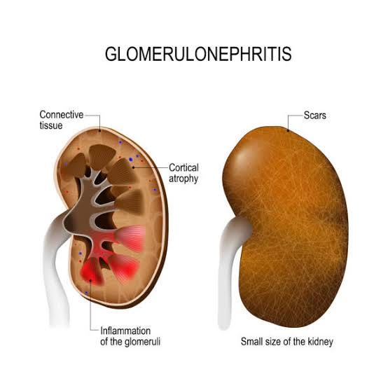 Glomerulonephritis. Glomerulonephritis | by Imdad Ullah | Medium