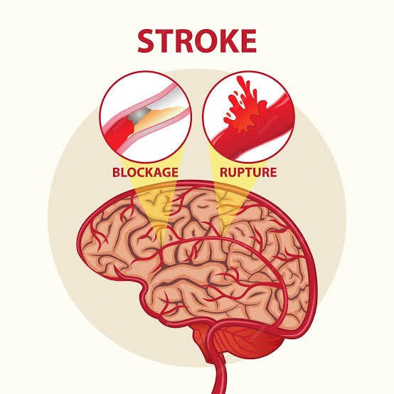 Stroke: Definisi, Penyebab, dan Gejala | by Musthofa Ramadhani | Dec ...