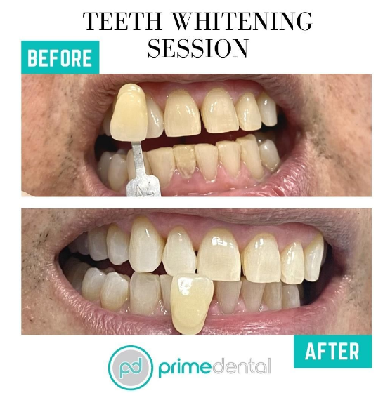 Unveiling the Secrets of Teeth Whitening: A Brighter Smile Awaits | by ...