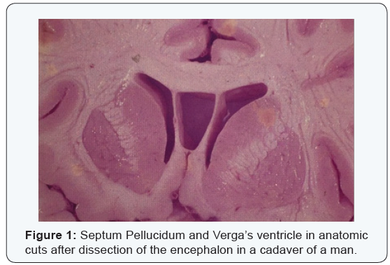 Cavum Septi Pellucidiet Vergae: Anatomic Finding and Review | by ...