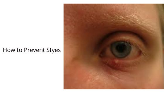 How to Prevent Styes. If you are having trouble with a stye… | by Rick ...