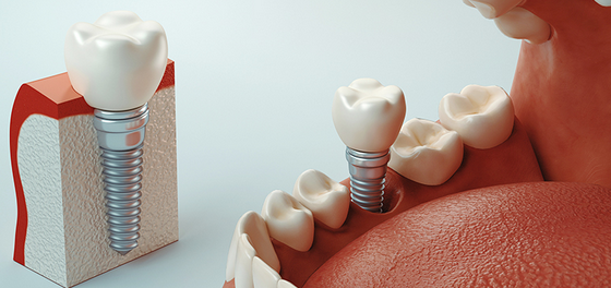 Understanding the Cost of Invisalign Braces in Solihull: A ...