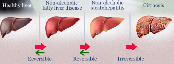 Non alcoholic fatty liver disease NUTRITION CARE | by Nutritive cure ...