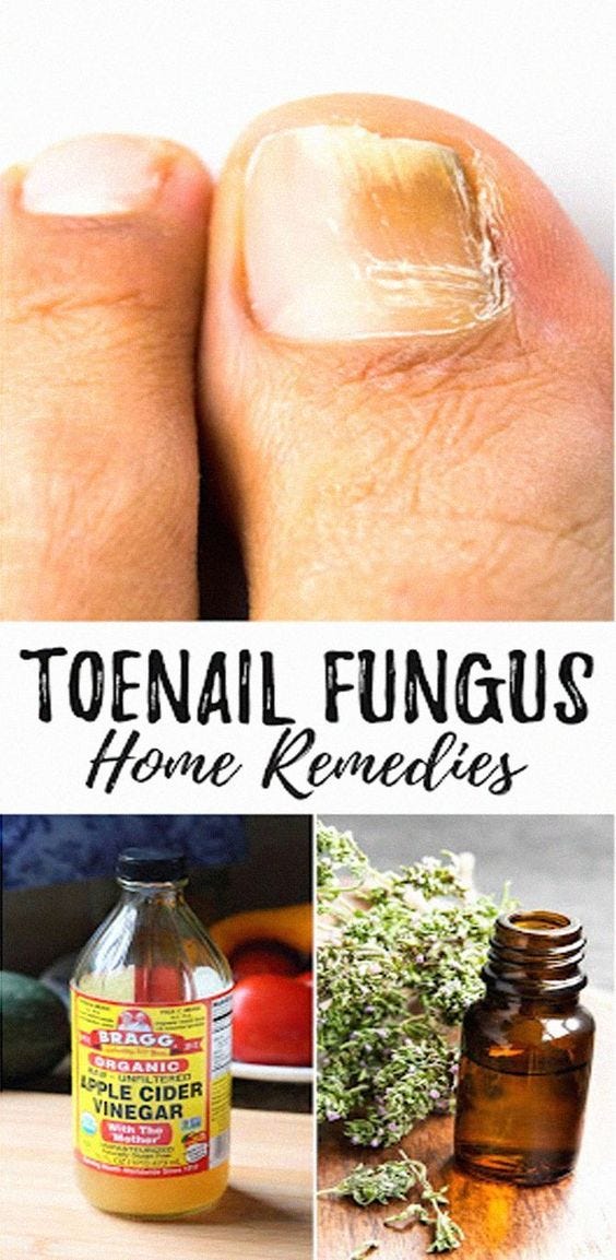 How To Use Hydrogen Peroxide For Nail Fungus — A Step By Step Guide ...