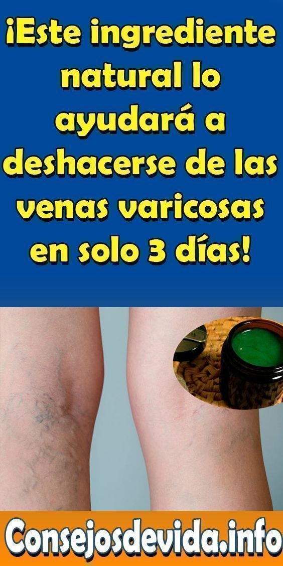 Tratamiento casero para eliminar las varices y arañitas en los pies ...