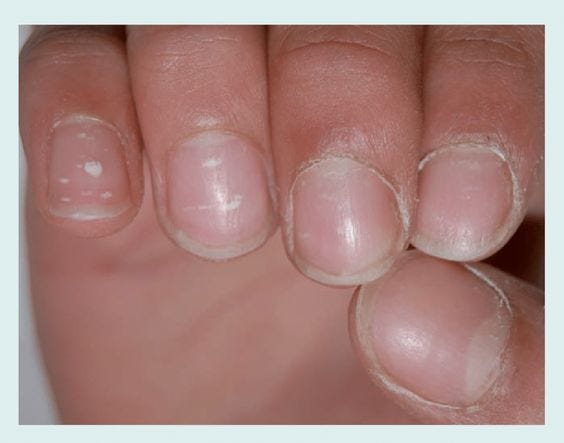 Zinc Deficiency Nails