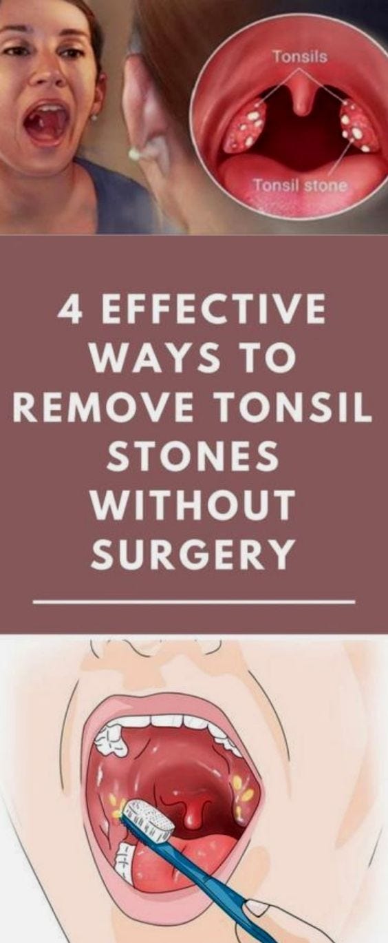 4 Effective Ways To Remove Tonsil Stones Without Surgery - Emily Blunt ...