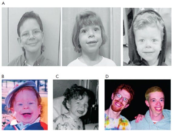 A Genetic Disorder — William’s Syndrome | by Pamela Oglesby ...