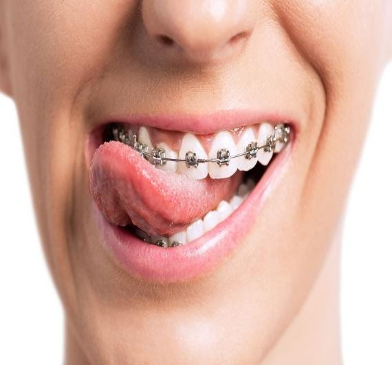 How Do Best Teeth Braces Correct Dental Problems? | by Smile Gallery ...