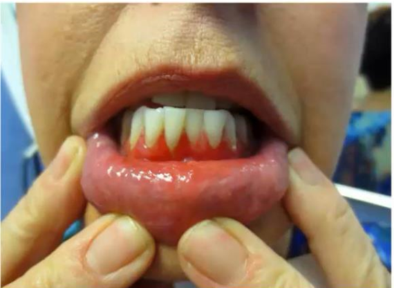 Pemphigus Vulgaris|What signs are characteristic of Pemphigus Vulgaris ...